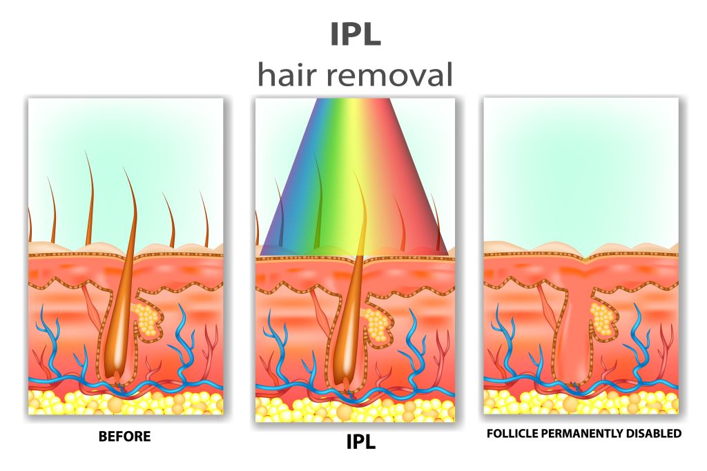 SUPER NANO LIGHT - IPL TRIỆT LÔNG & TRẺ HÓA DA - Mỹ Viện Thế Giới Sắc Đẹp